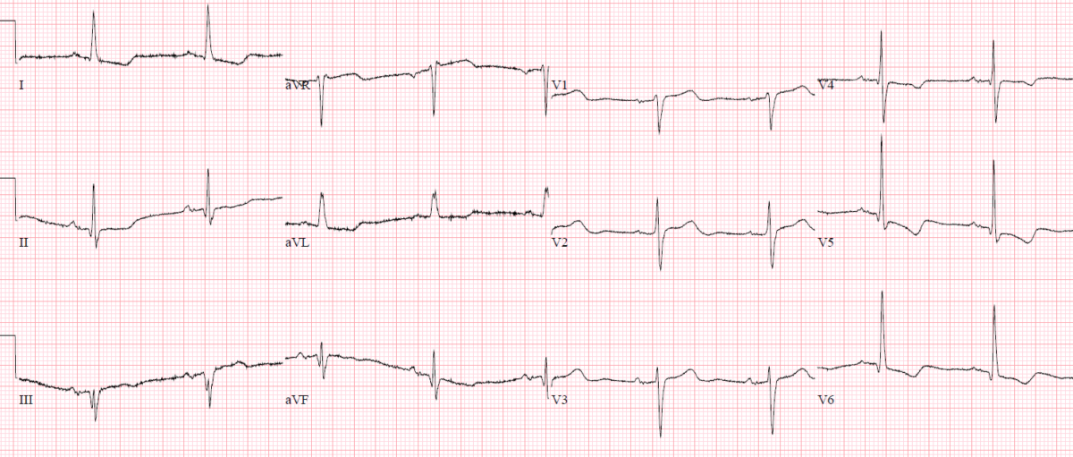 ECG Cases 16: poor R-wave progression - LATE mnemonic | ECG Cases