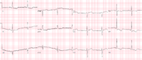 ECG Cases 16: poor R-wave progression - LATE mnemonic | ECG Cases