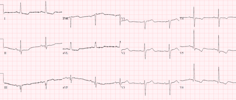 ECG Cases 16: poor R-wave progression - LATE mnemonic | ECG Cases
