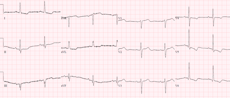 ECG Cases 16: poor R-wave progression - LATE mnemonic | ECG Cases