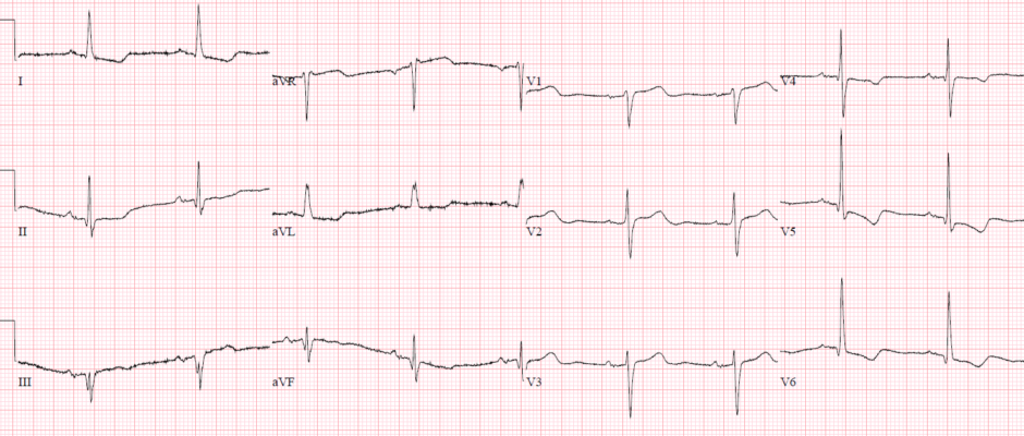 ECG Cases 16: poor R-wave progression - LATE mnemonic | ECG Cases