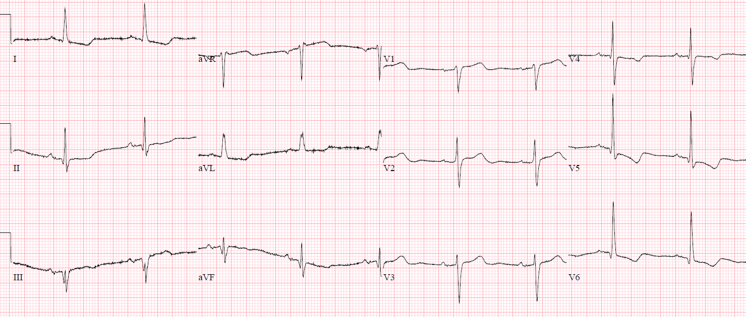 ECG Cases 16: poor R-wave progression - LATE mnemonic | ECG Cases