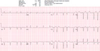 ECG Cases 16: poor R-wave progression - LATE mnemonic | ECG Cases