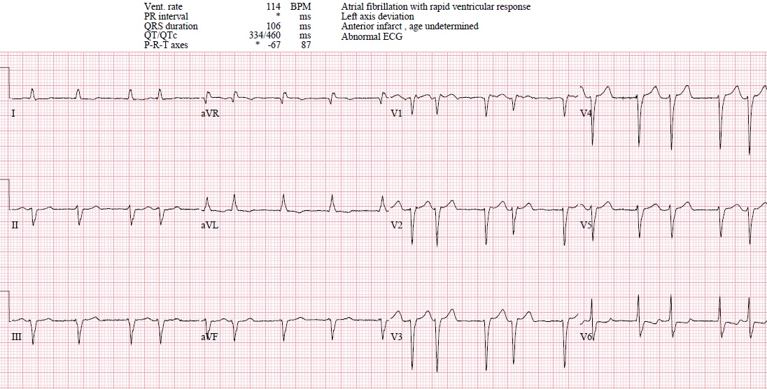 ECG Cases 16: poor R-wave progression - LATE mnemonic | ECG Cases