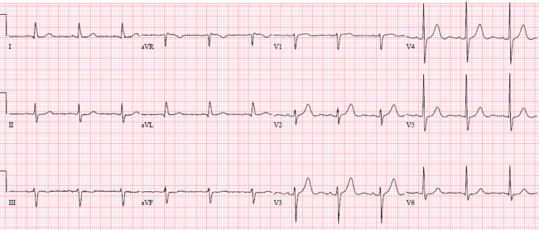 ECG Cases 16: poor R-wave progression - LATE mnemonic | ECG Cases