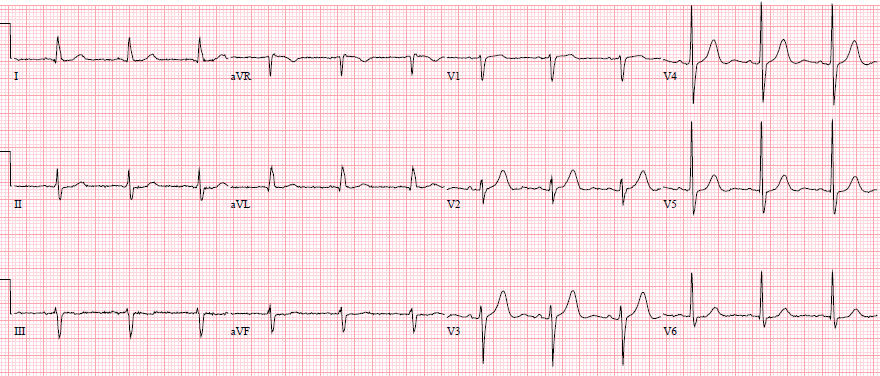 ECG Cases 16: poor R-wave progression - LATE mnemonic | ECG Cases