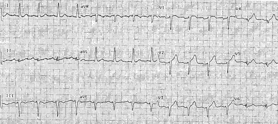 ECG Cases 16: poor R-wave progression - LATE mnemonic | ECG Cases