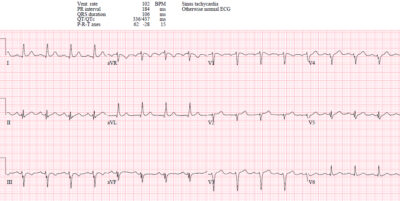 ECG Cases 16: poor R-wave progression - LATE mnemonic | ECG Cases