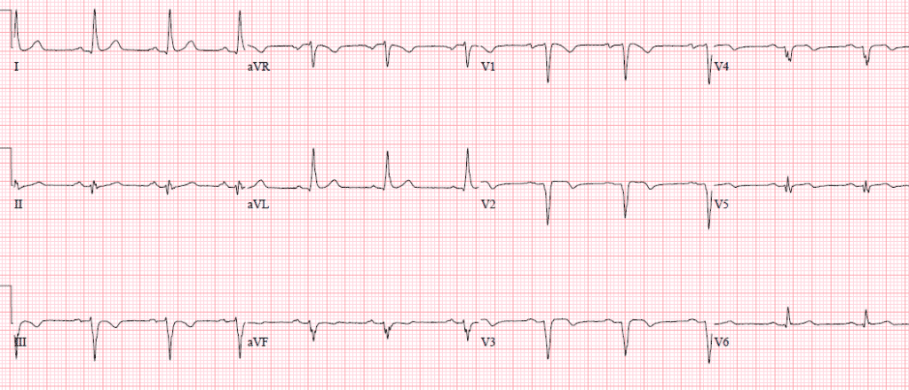 R Wave Ecg