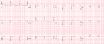 ECG Cases 16: poor R-wave progression - LATE mnemonic | ECG Cases