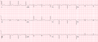 ECG Cases 16: poor R-wave progression - LATE mnemonic | ECG Cases