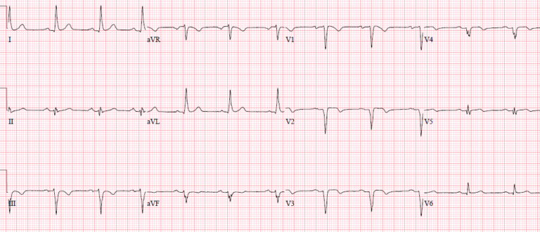 ECG Cases 16: poor R-wave progression - LATE mnemonic | ECG Cases