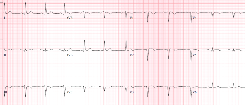 ECG Cases 16: poor R-wave progression - LATE mnemonic | ECG Cases