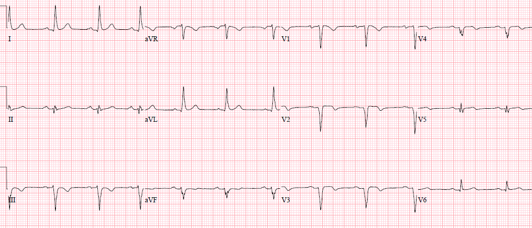 ECG Cases 16: poor R-wave progression - LATE mnemonic | ECG Cases