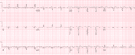 ECG Cases 16: poor R-wave progression - LATE mnemonic | ECG Cases