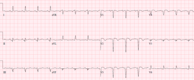 ECG Cases 16: poor R-wave progression - LATE mnemonic | ECG Cases