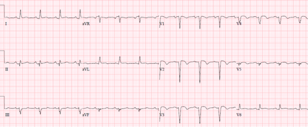 ECG Cases 16: poor R-wave progression - LATE mnemonic | ECG Cases