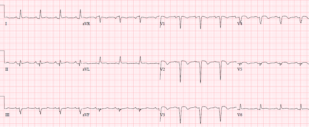 ECG Cases 16: poor R-wave progression - LATE mnemonic | ECG Cases