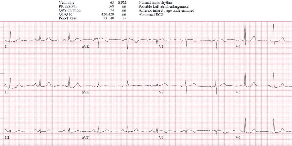 ECG Cases 16: poor R-wave progression - LATE mnemonic | ECG Cases