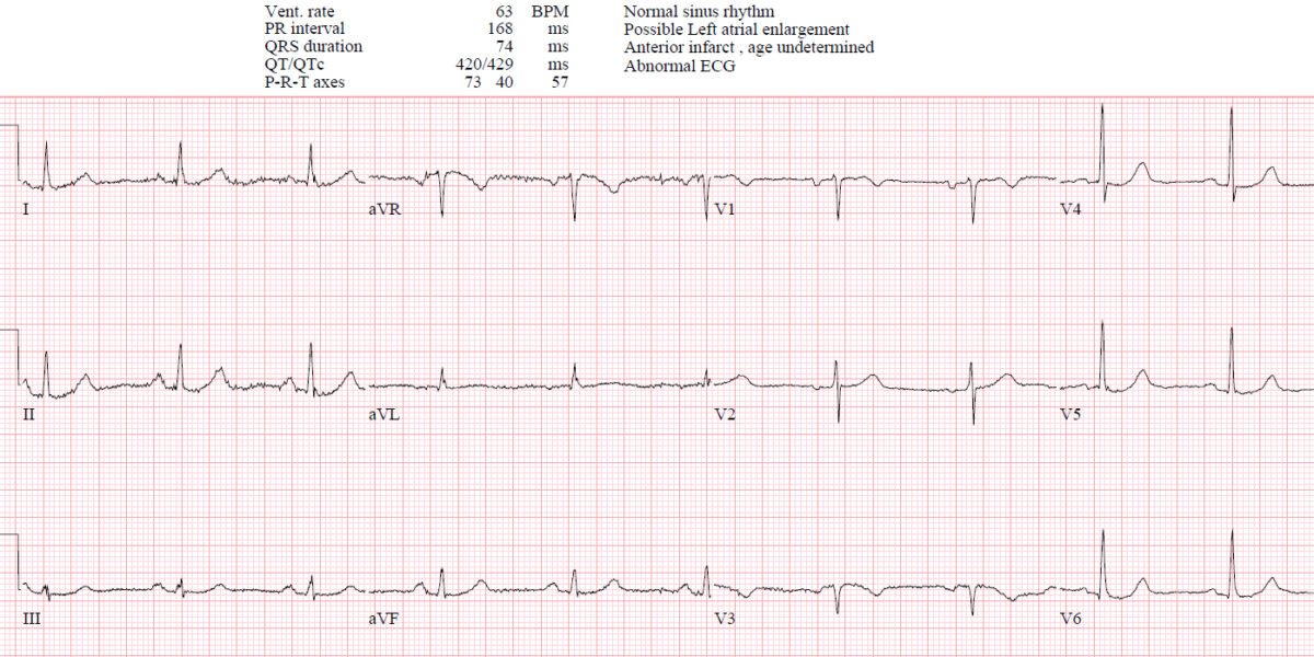 ECG Cases 16: poor R-wave progression - LATE mnemonic | ECG Cases