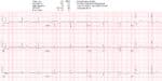 ECG Cases 16: poor R-wave progression - LATE mnemonic | ECG Cases