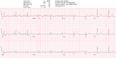 ECG Cases 16: poor R-wave progression - LATE mnemonic | ECG Cases