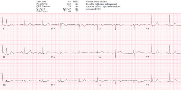 ECG Cases 16: poor R-wave progression - LATE mnemonic | ECG Cases