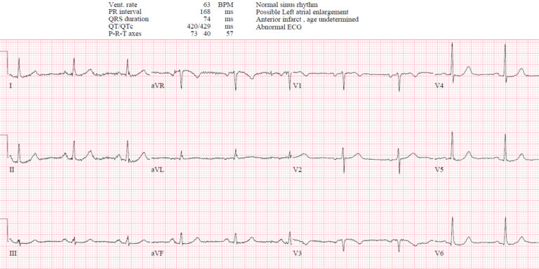 ECG Cases 16: poor R-wave progression - LATE mnemonic | ECG Cases