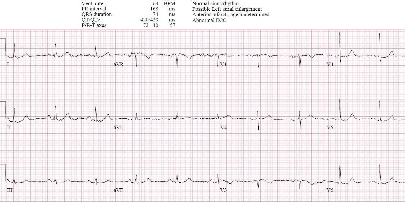 ECG Cases 16: poor R-wave progression - LATE mnemonic | ECG Cases