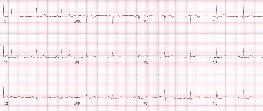 ECG Cases 16: poor R-wave progression - LATE mnemonic | ECG Cases