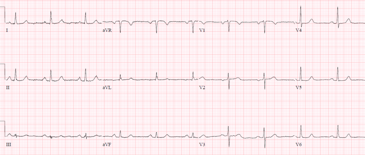 ECG Cases 16: poor R-wave progression - LATE mnemonic | ECG Cases