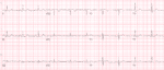 ECG Cases 16: poor R-wave progression - LATE mnemonic | ECG Cases