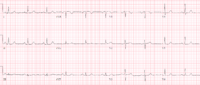 ECG Cases 16: poor R-wave progression - LATE mnemonic | ECG Cases
