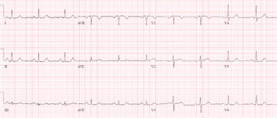 ECG Cases 16: poor R-wave progression - LATE mnemonic | ECG Cases
