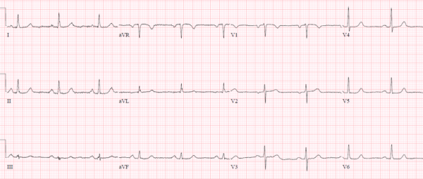 ECG Cases 16: poor R-wave progression - LATE mnemonic | ECG Cases