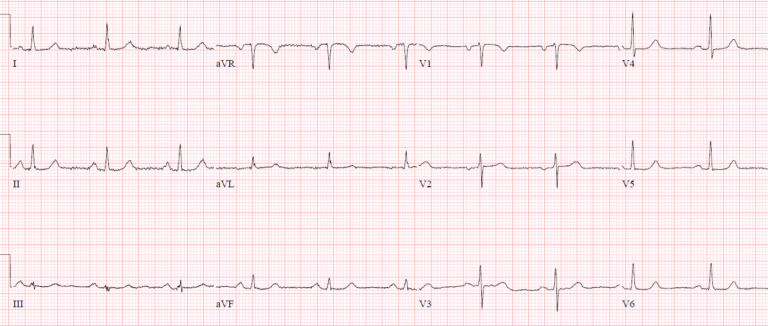 ECG Cases 16: poor R-wave progression - LATE mnemonic | ECG Cases