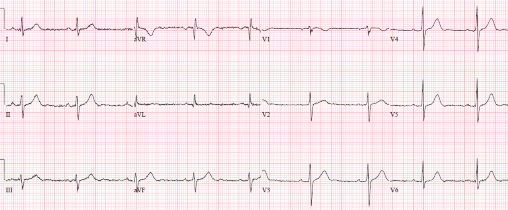 ECG Cases 16: poor R-wave progression - LATE mnemonic | ECG Cases