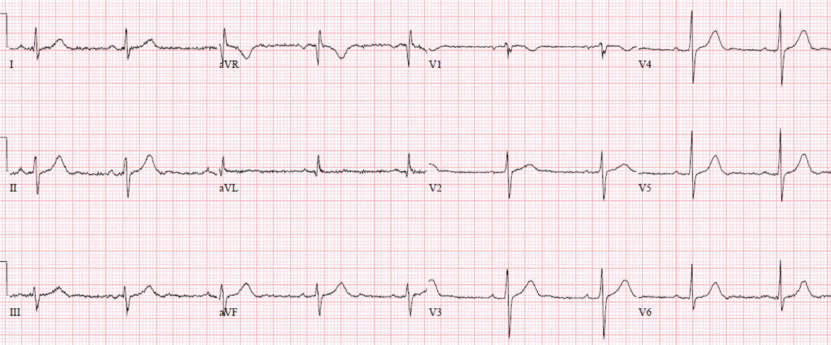 ECG Cases 16: poor R-wave progression - LATE mnemonic | ECG Cases
