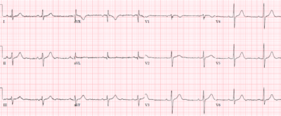 ECG Cases 16: poor R-wave progression - LATE mnemonic | ECG Cases