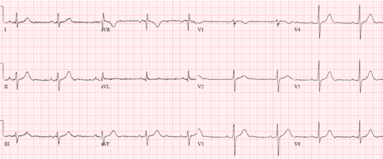 ECG Cases 16: poor R-wave progression - LATE mnemonic | ECG Cases