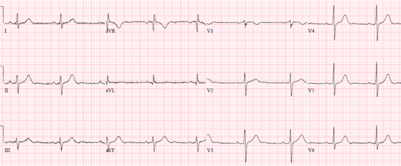 ECG Cases 16: poor R-wave progression - LATE mnemonic | ECG Cases