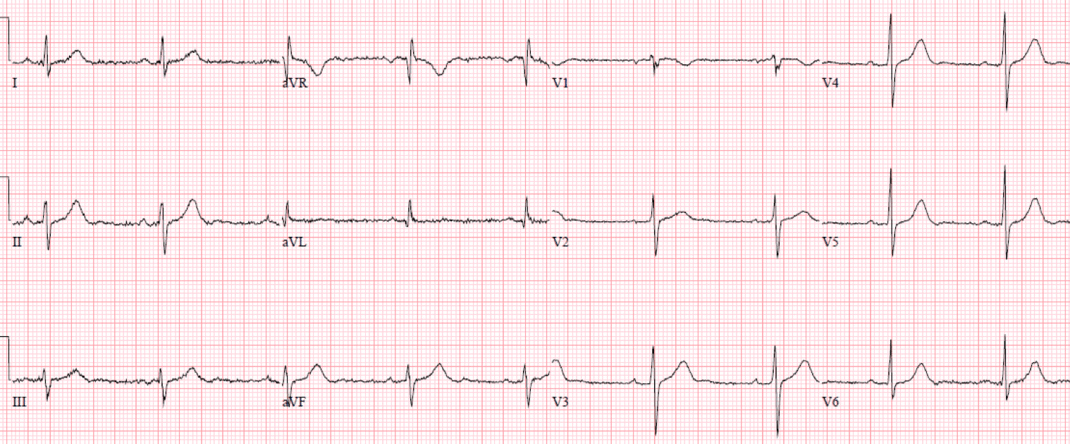 ECG Cases 16: poor R-wave progression - LATE mnemonic | ECG Cases