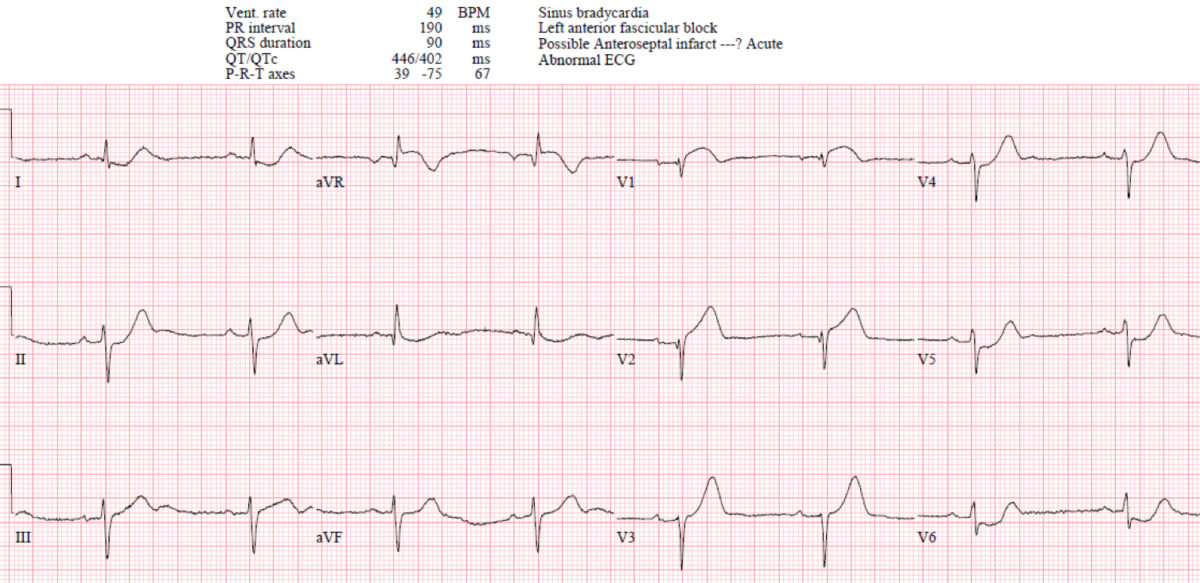 ECG Cases 16: poor R-wave progression - LATE mnemonic | ECG Cases