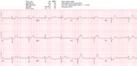 ECG Cases 16: poor R-wave progression - LATE mnemonic | ECG Cases