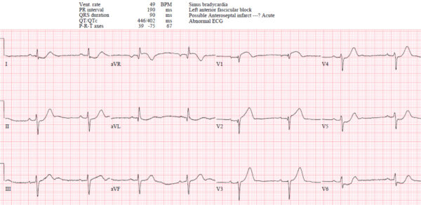 ECG Cases 16: poor R-wave progression - LATE mnemonic | ECG Cases
