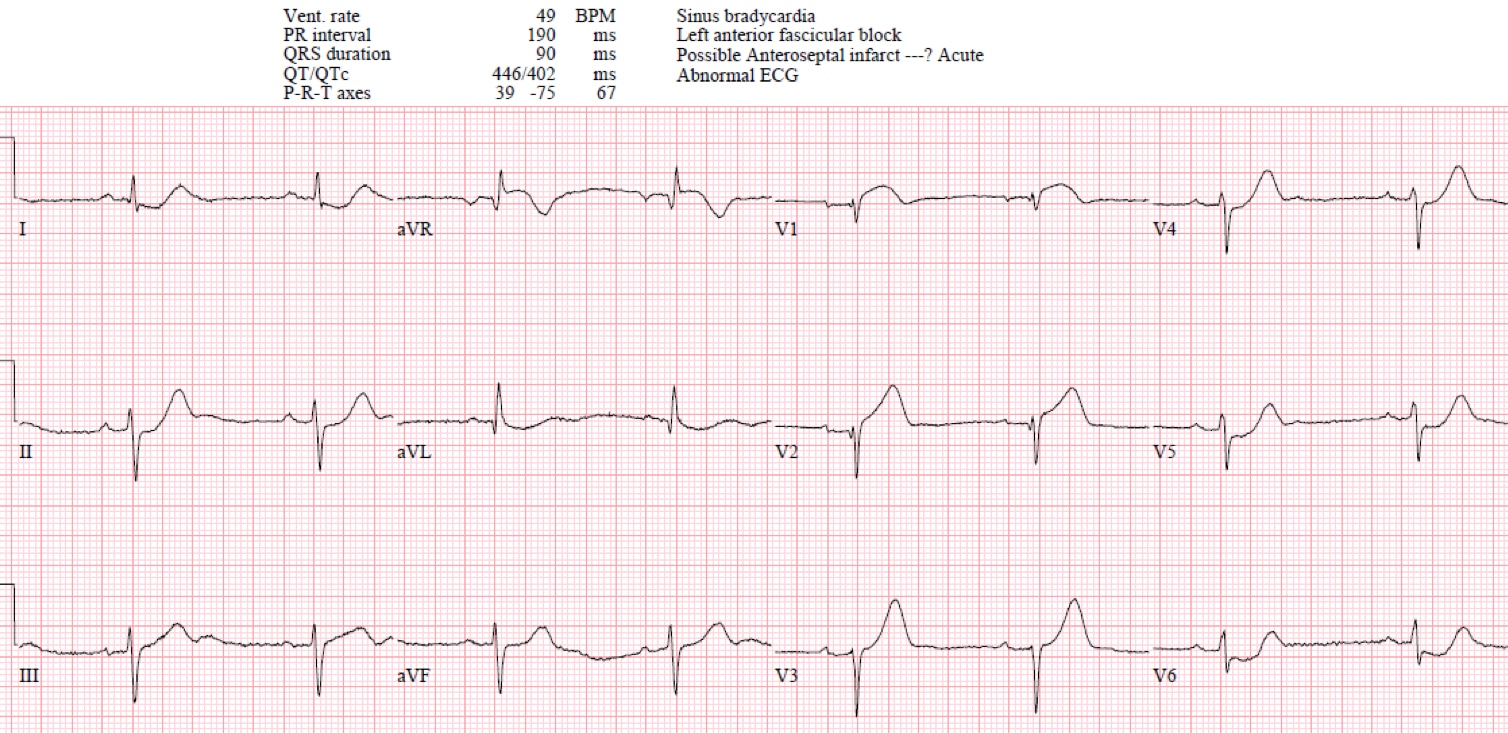 ECG Cases 16: poor R-wave progression - LATE mnemonic | ECG Cases