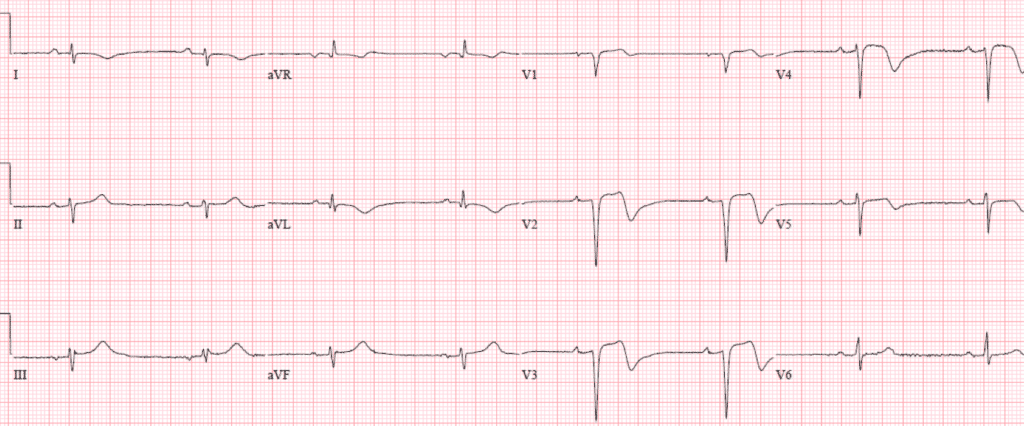 ECG Cases 16: poor R-wave progression - LATE mnemonic | ECG Cases