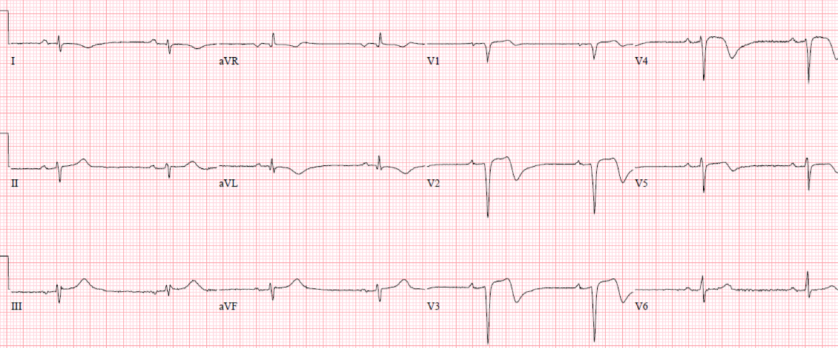 ECG Cases 16: poor R-wave progression - LATE mnemonic | ECG Cases
