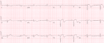 ECG Cases 16: poor R-wave progression - LATE mnemonic | ECG Cases