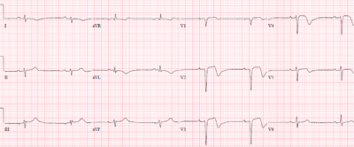 ECG Cases 16: poor R-wave progression - LATE mnemonic | ECG Cases